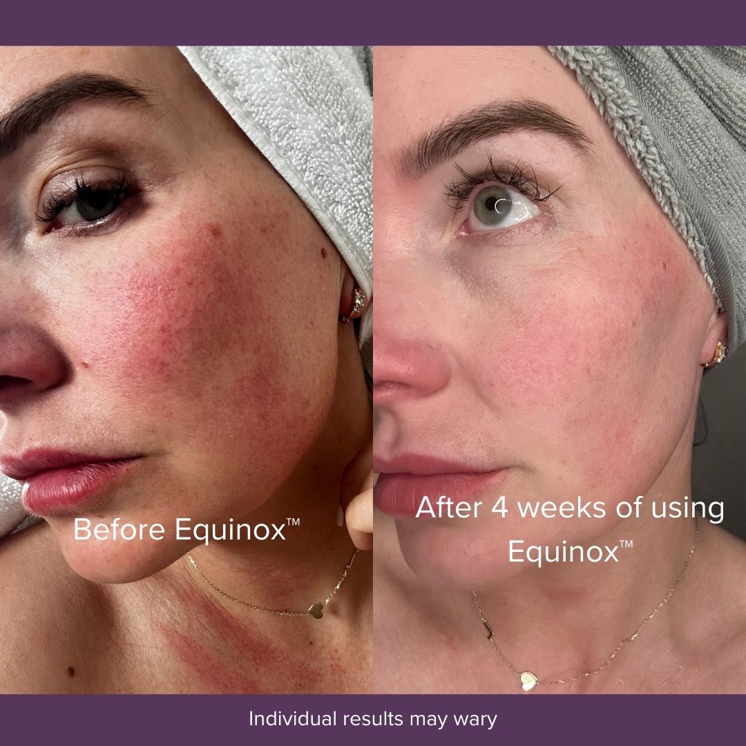 Equinox™ Pro LED Mask - Lights On, Problems Off – Luyors