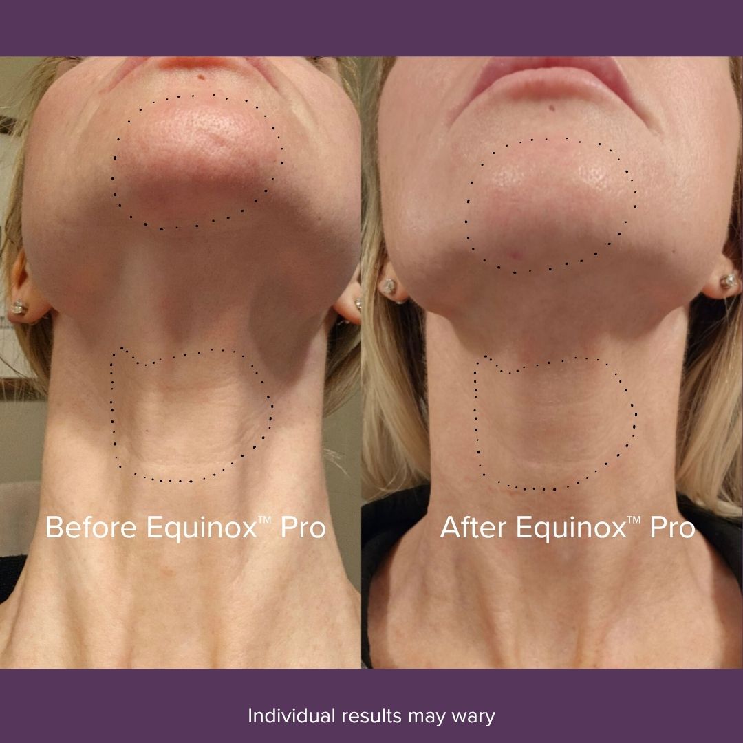 Equinox™ Pro LED Mask - Lights On, Problems Off – Luyors